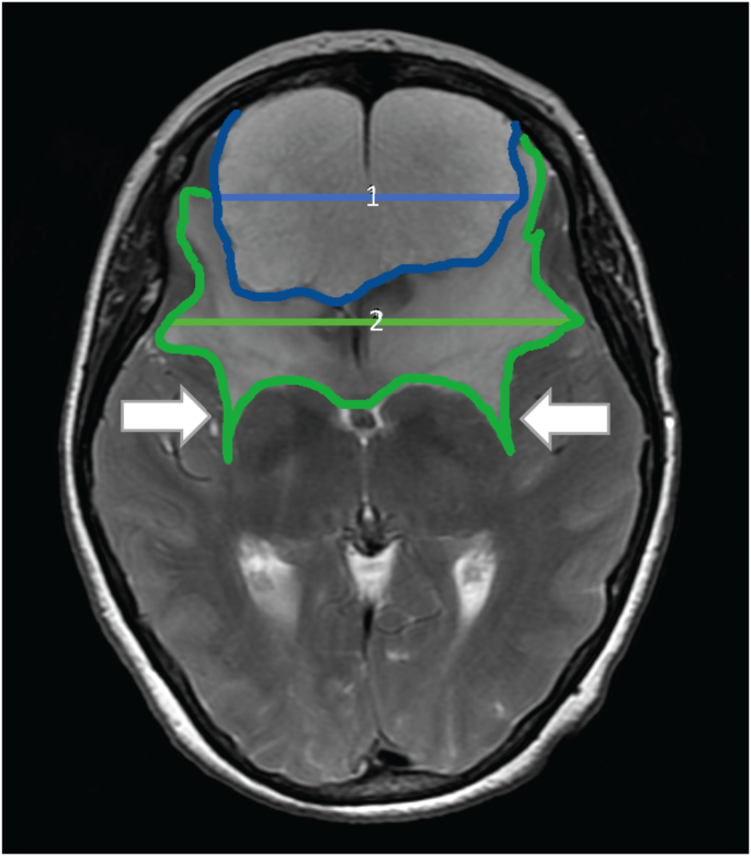 Single-stage versus two-stage resection for large anterior midline ...