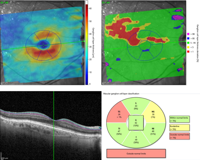 Retinal neurodegeneration, neuroretinal rim analysis and choroid ...