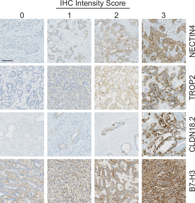 Profiling ADC targets in cholangiocarcinoma: implications for ...
