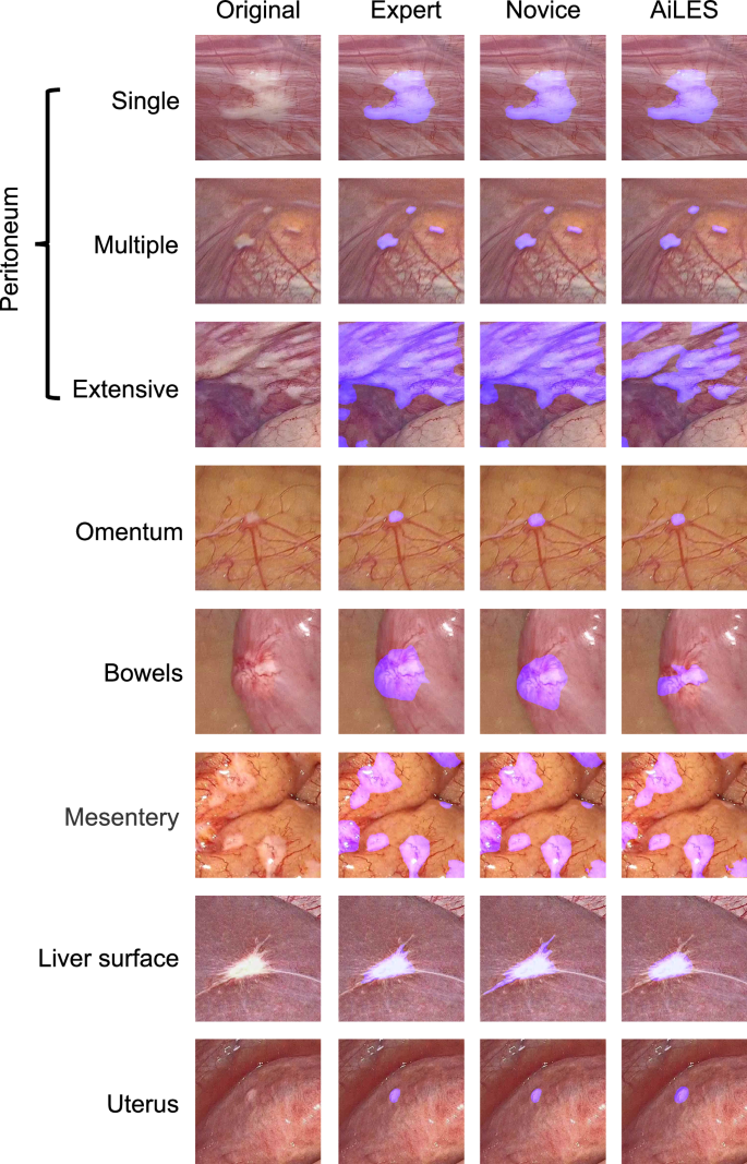 Artificial intelligence assisted real-time recognition of intra ...