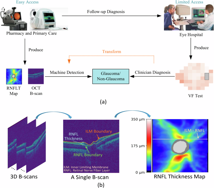 Equitable artificial intelligence for glaucoma screening with fair ...