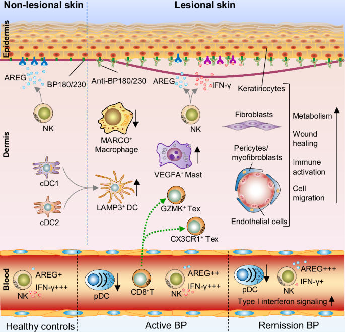 Single cell transcriptome profiling reveals pathogenesis of bullous ...