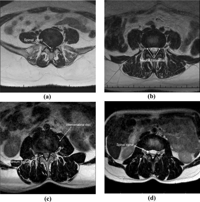 MRI-based classification of lumbar spinal stenosis using a hybrid ...