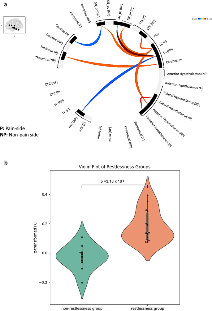 Uncovering the neurological substrates underlying restlessness in ...