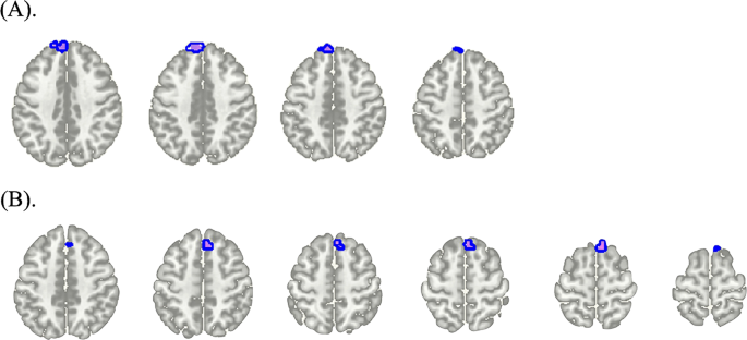 Uncovering the neurological substrates underlying restlessness in ...