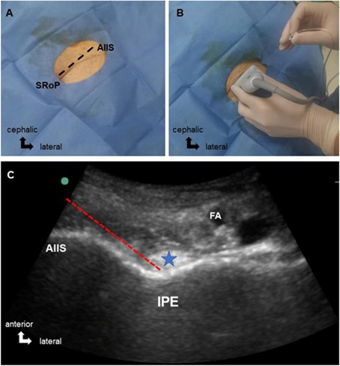 The effect of pericapsular nerve group (PENG) block on postoperative ...