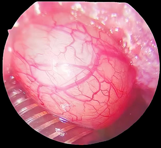Asymptomatic giant epiglottic cyst causing an unexpectedly difficult ...