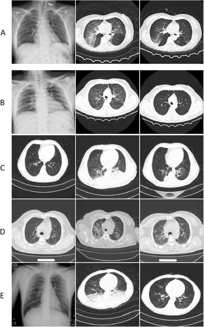 Negative pressure pulmonary edema resulting from upper airway ...