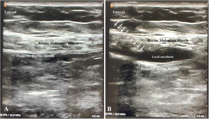 Rectus sheath blocks for pediatric laparoscopic appendicectomy | BMC ...