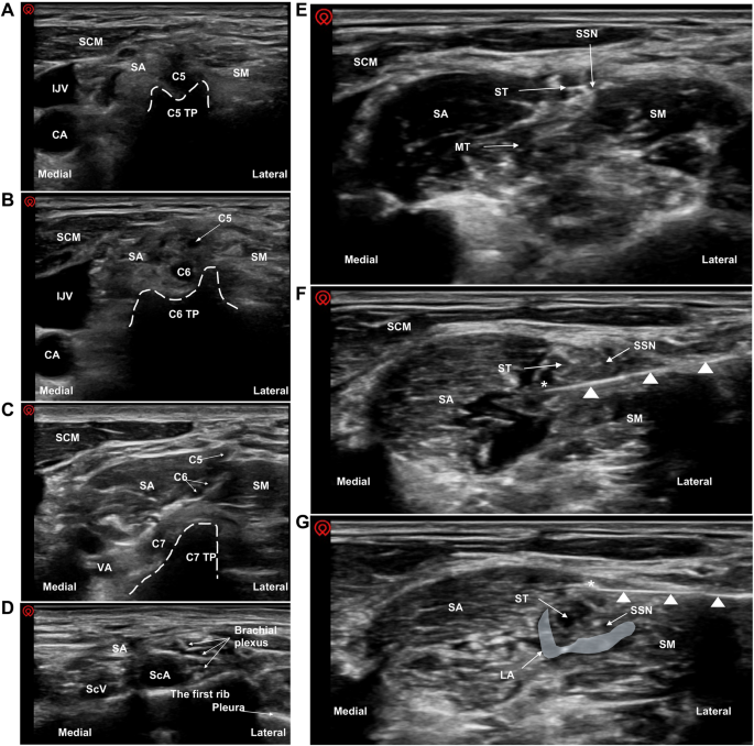 Optimizing the superior trunk block for arthroscopic shoulder surgery ...