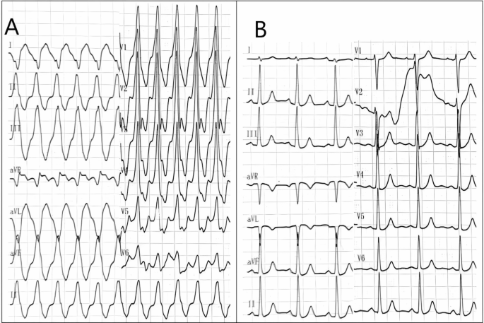 Left atrioventricular accessory pathway with Mahaim fiber ...