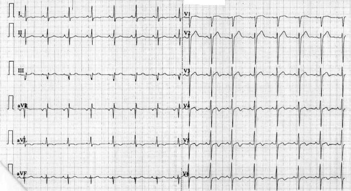 Electrocardiographic precedence with rapid anatomical progression in ...