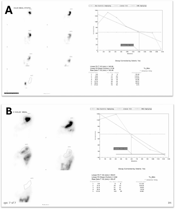 Clinical insights into diabetic gastroparesis: gastric scintigraphy ...