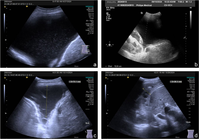 Hepatic hydrothorax in the absence of ascites with mixed bacterial and ...