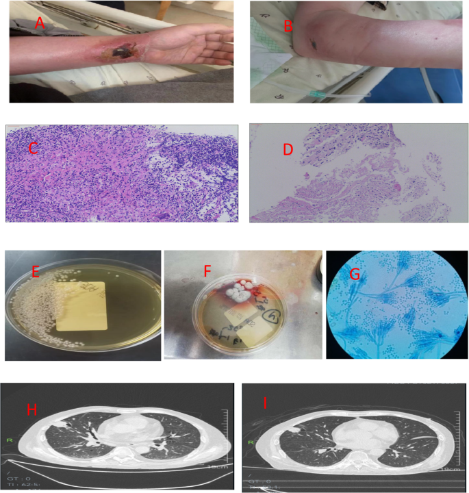 Disseminated Talaromyces marneffei infection in a patient with ...