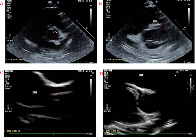 A case report of severe Mycoplasma pneumoniae pneumonia complicated by ...