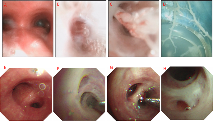 A case report of severe Mycoplasma pneumoniae pneumonia complicated by ...