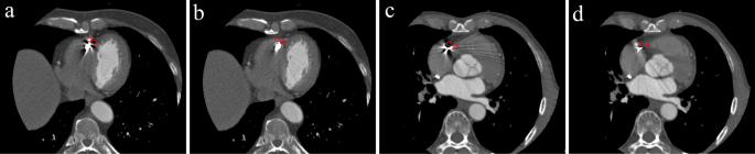Reduction of metallic artifacts from the novel leadless pacemaker using ...