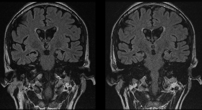 A fatal familial insomnia patient initially misdiagnosed as Alzheimer’s ...