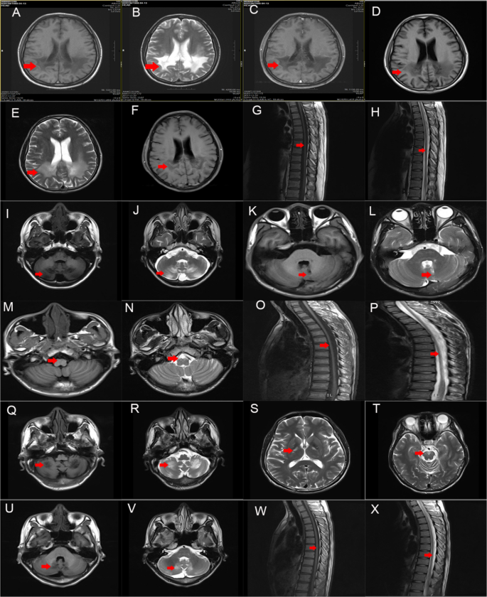 Clinical and radiological characteristics of adult-onset X-linked ...