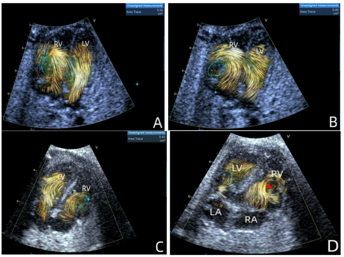 Vortex formation of cardiac bilateral ventricles in fetuses with ...