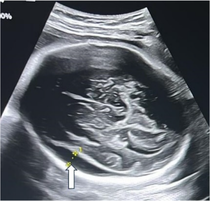 Fetal subdural hematoma in a pregnant woman on low-dose aspirin ...