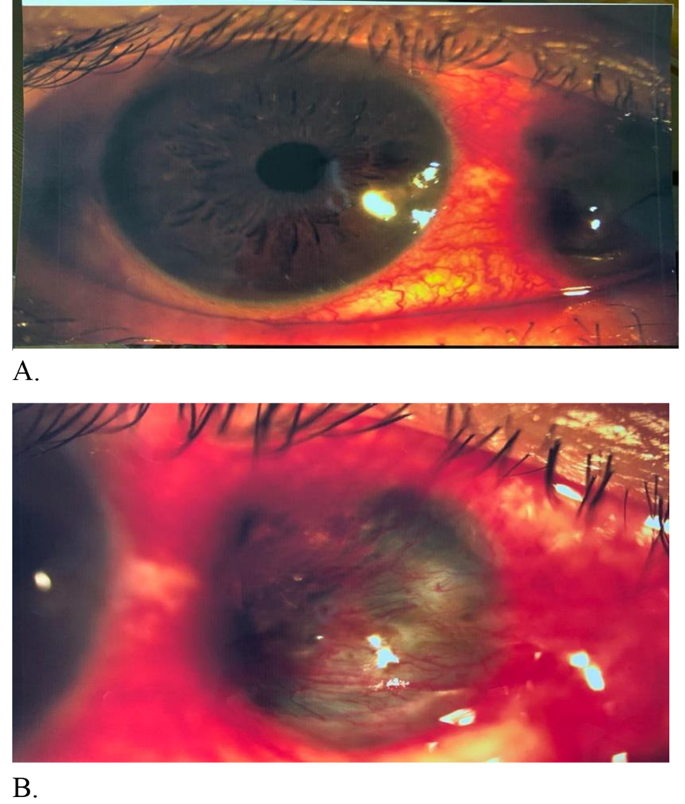 Isolated conjunctival cavernous hemangioma: a rare case report | BMC ...