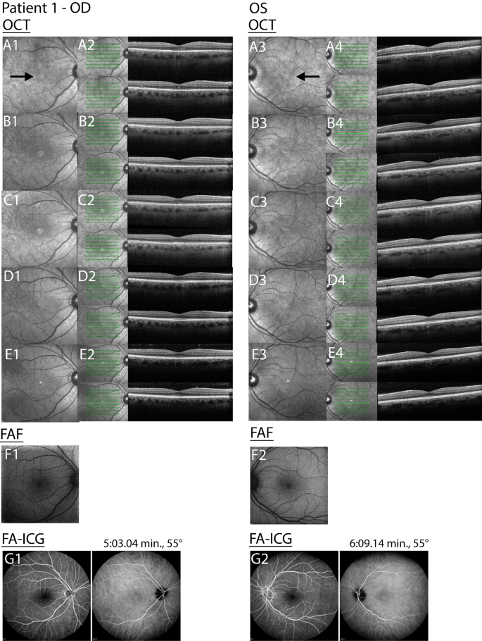 Acute retinal pigment epitheliitis using adaptive optics imaging: a ...