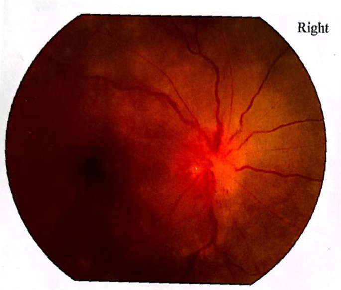 Optic neuropathy as an initial manifestation of acute retinal necrosis ...