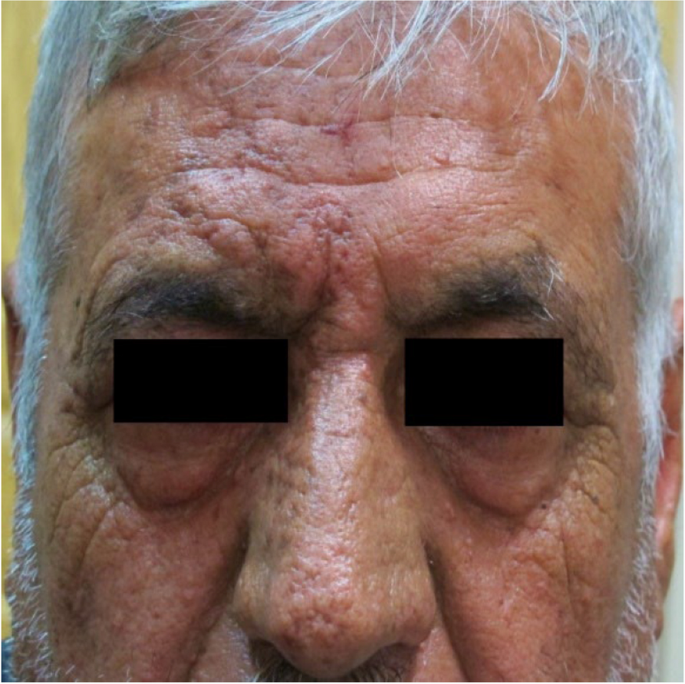 Herpes zoster ophthalmicus with acute retrobulbar optic neuritis and ...