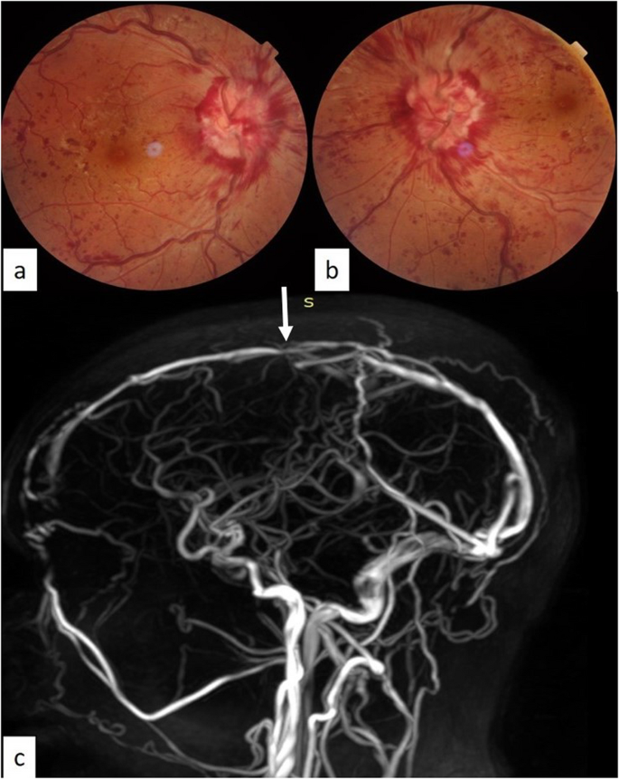 Acute bilateral vision loss secondary to cerebral venous thrombosis ...