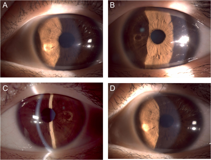 Halo sign in keratoconus: a case report | BMC Ophthalmology | Springer ...