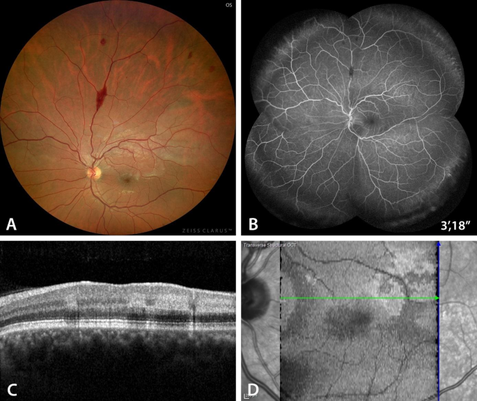 A case of paracentral acute middle maculopathy and retinal vein ...