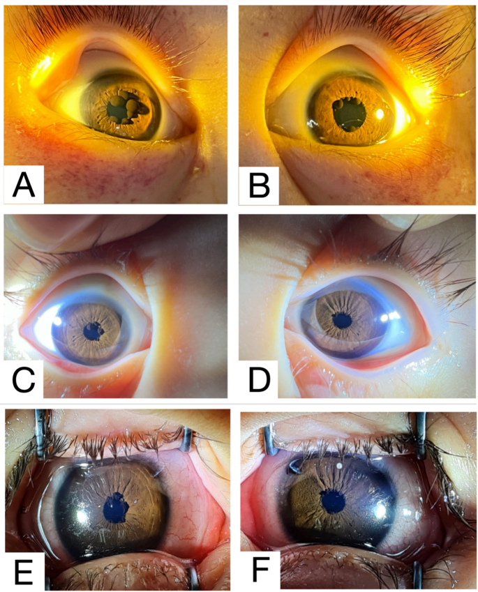 Iris pigment epithelial cysts in acute lymphoblastic leukemia-a case ...