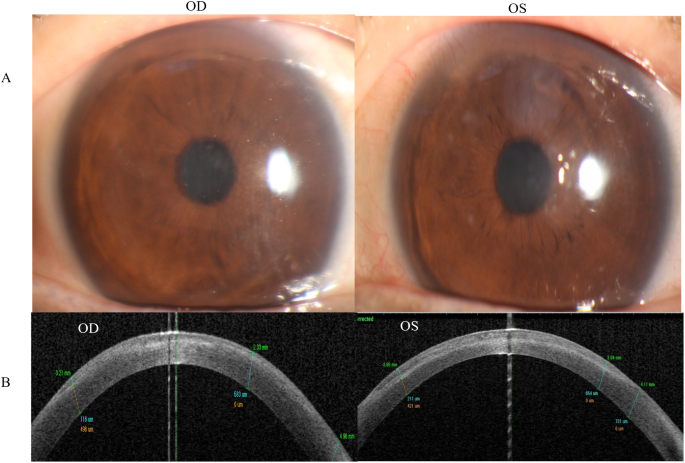 Non-traumatic bilateral corneal flap dislocation 20 years after LASIK ...