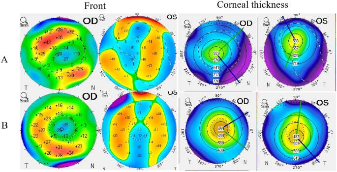 Non-traumatic bilateral corneal flap dislocation 20 years after LASIK ...