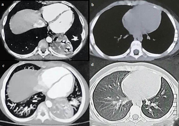 Refractory type 1 plastic bronchitis in a child; case report | BMC ...