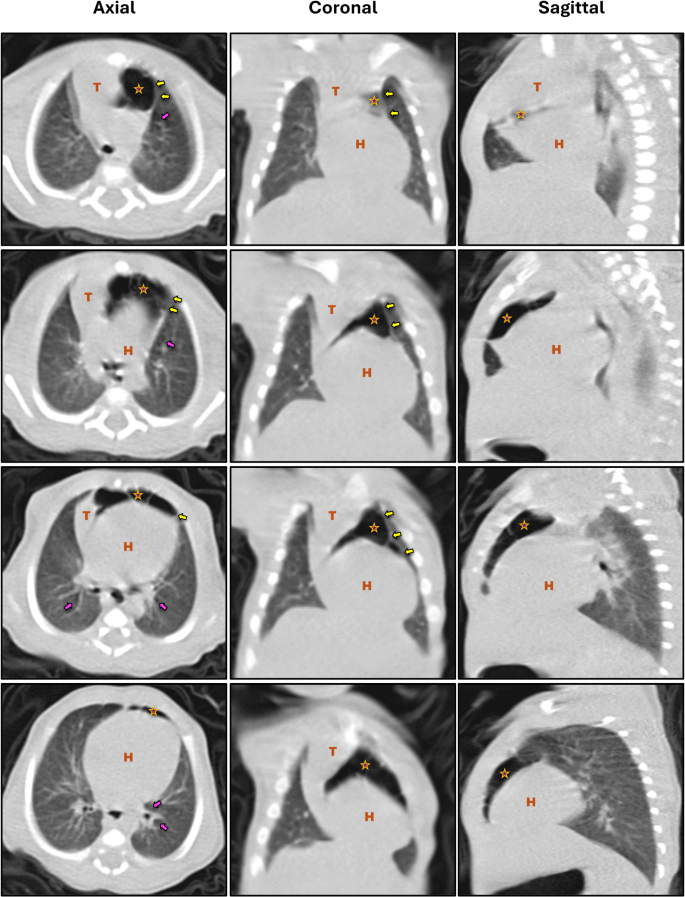 Spinnaker-sail sign in full-term neonates with spontaneous ...