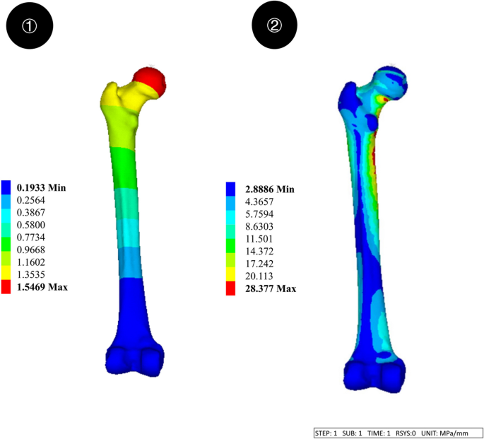 Biomechanical effects of FNS on femoral neck fractures based on ...