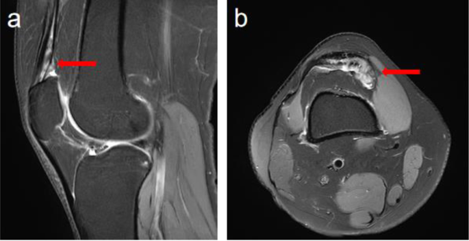 Quadriceps tendon reconstruction with LARS ligament due to fibroma of ...