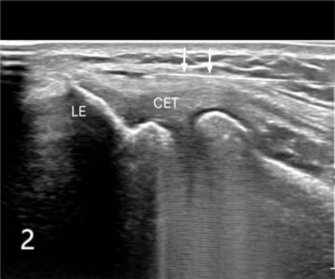 Multimodal ultrasound assessment of the injection therapy in lateral ...