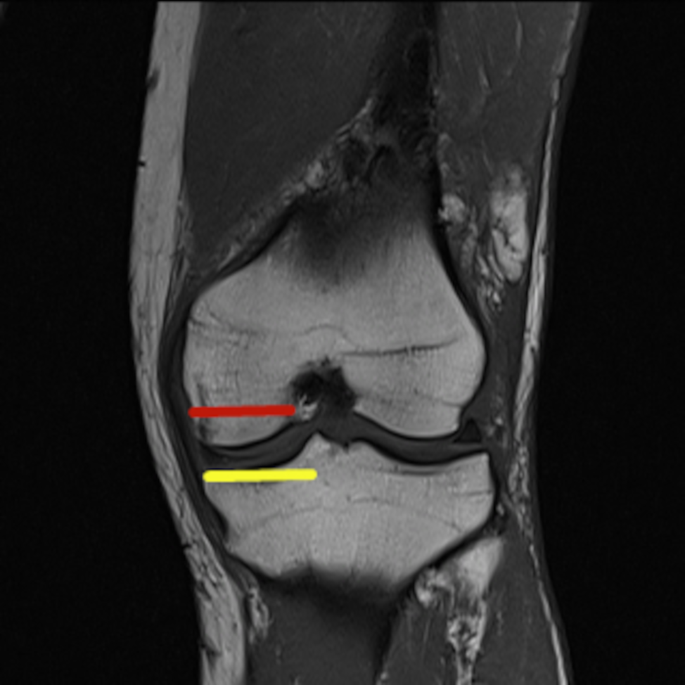Association between anatomical risk factors and medial meniscus ...