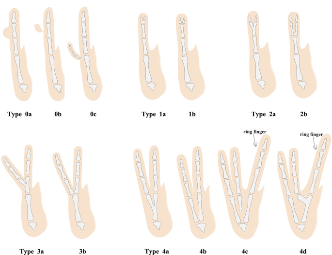 Ulnar polydactyly of the hand: a classification system and clinical series | BMC Musculoskeletal ...