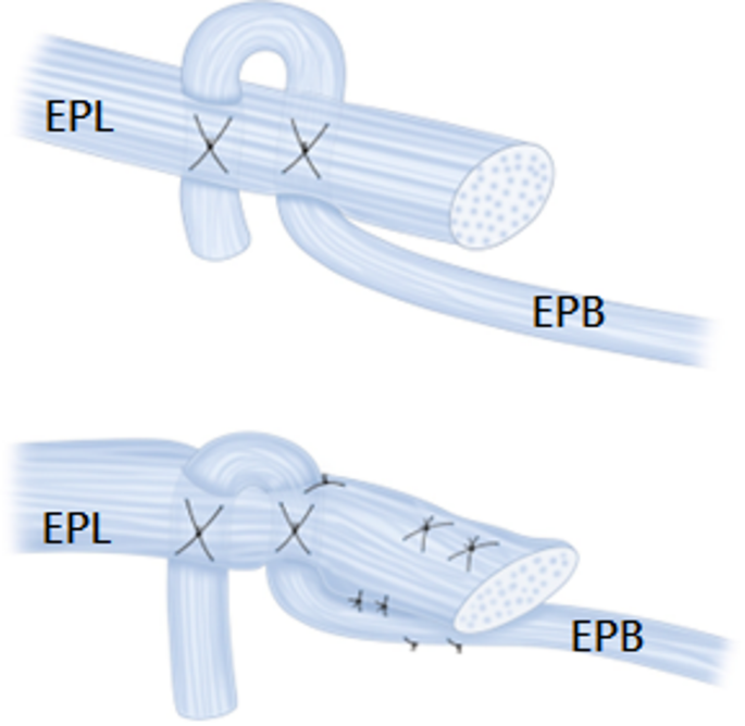 A straightforward tendon transfer technique for extensor pollicis ...