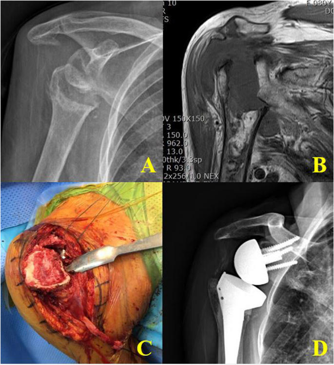 Rapidly progressive destructive arthrosis (RPDA) of the glenohumeral ...