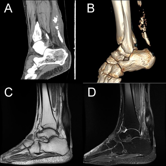 Giant calcific insertional Achilles tendinopathy with Haglund’s ...
