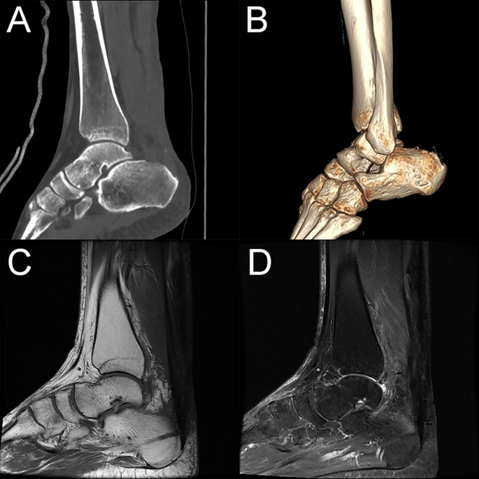 Giant calcific insertional Achilles tendinopathy with Haglund’s ...