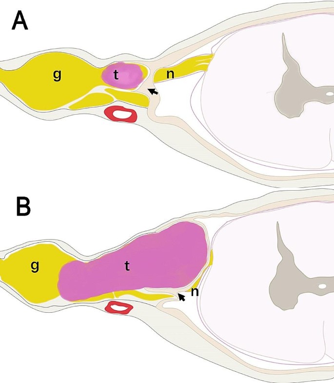 A separate-dural-incision method of extradural dumbbell spinal ...