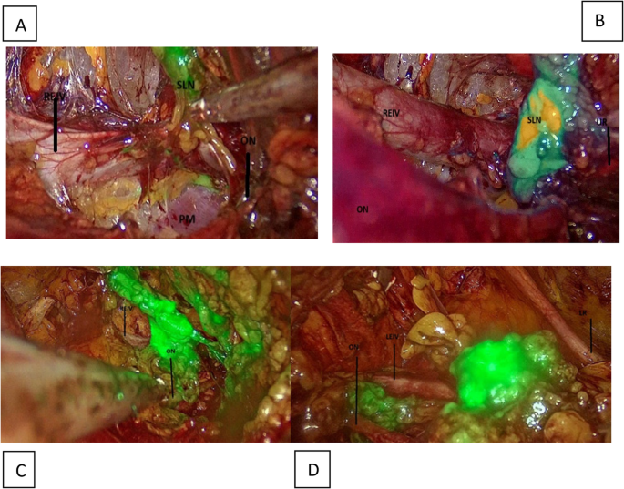 Comparison of identification of sentinel lymph nodes between ICG vs ...