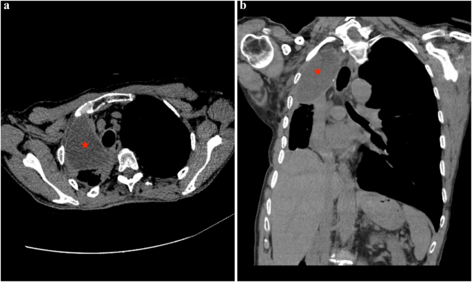 Transbronchial EBUS-guided aspiration of a loculated pleural collection ...
